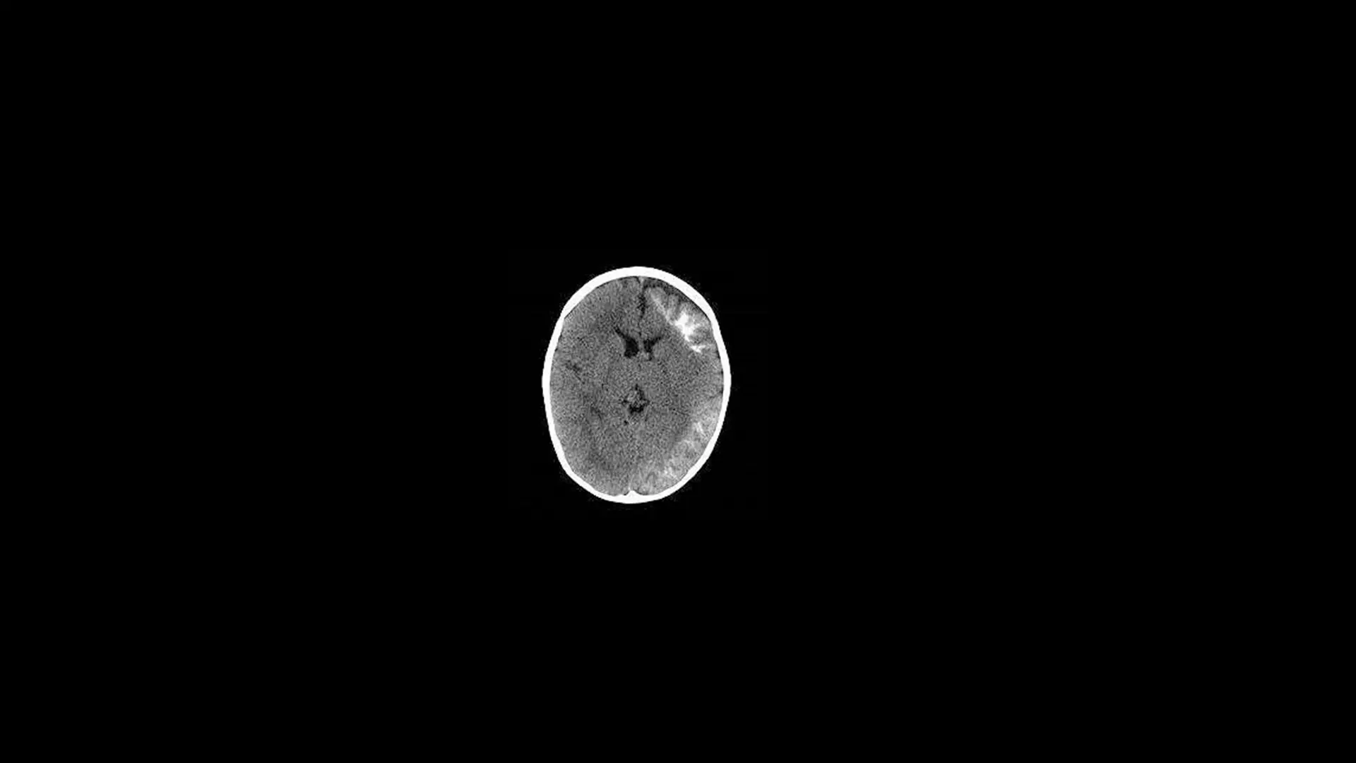 ZY Therapeutics develops Kamini for brain calcification in rare CNS ...